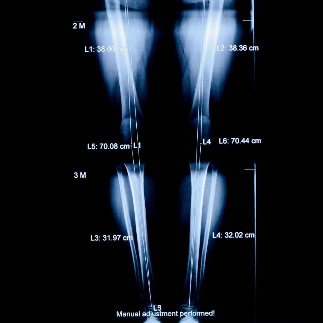 Computer-Assisted Navigation For Total Knee Replacement - DePaolo ...